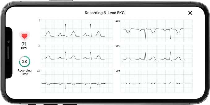 ECG Monitor - AT HOME MONITORING